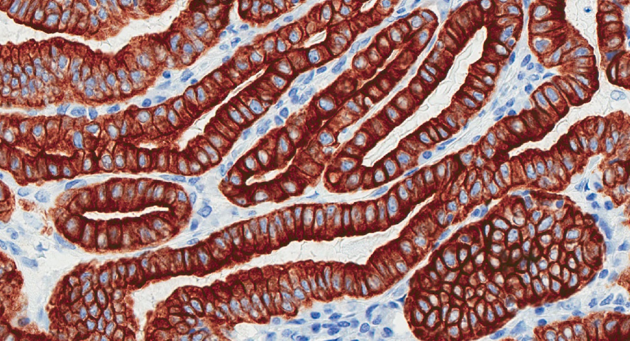 Pathology Outlines - Tall cell