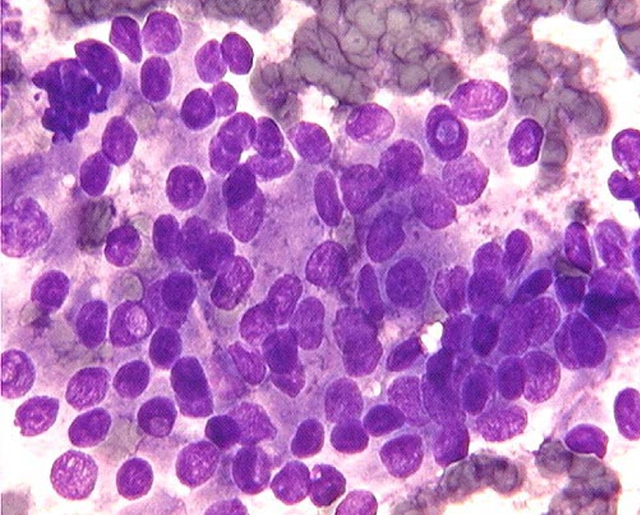 Pathology Outlines - Tall cell