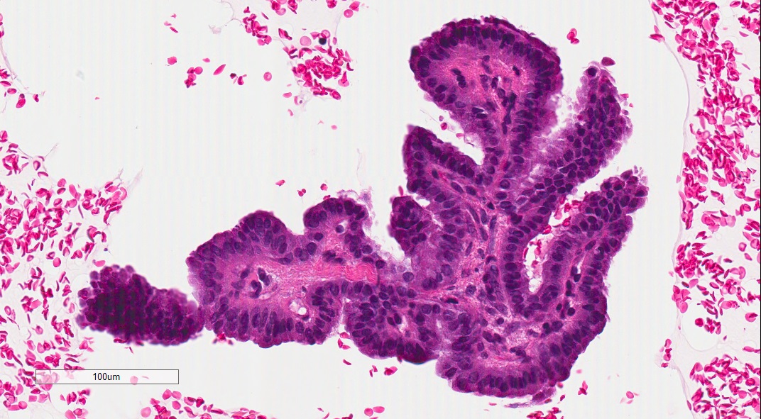 Pathology Outlines - Tall cell