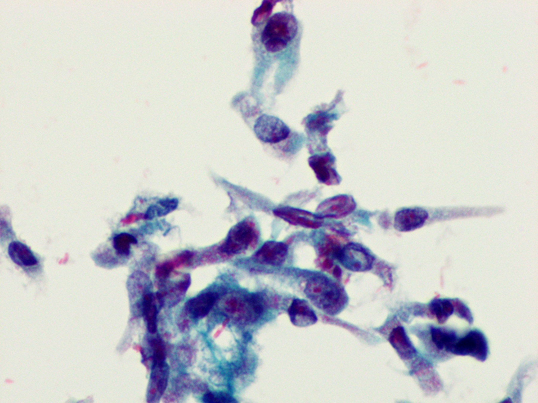 Pathology Outlines - Tall cell