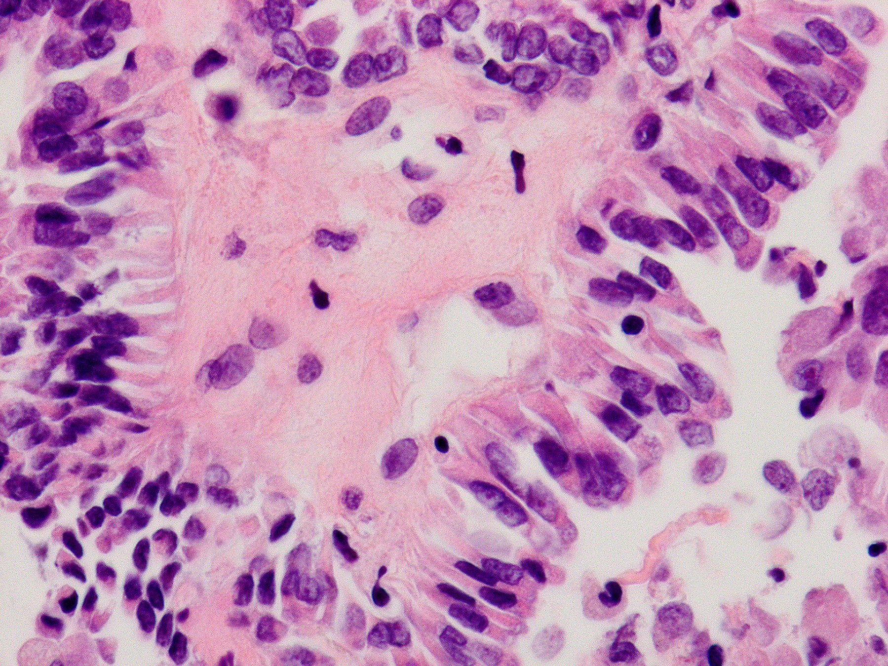 Pathology Outlines - Tall cell