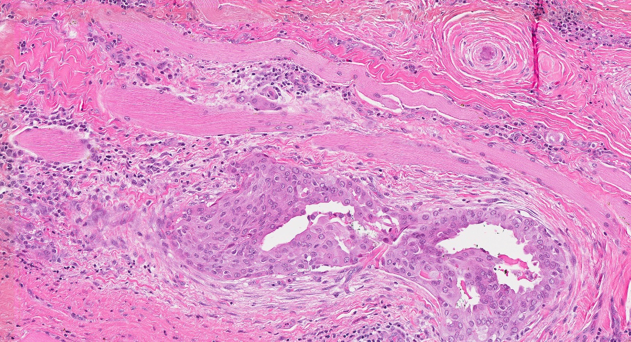 Pathology Outlines - Tall cell