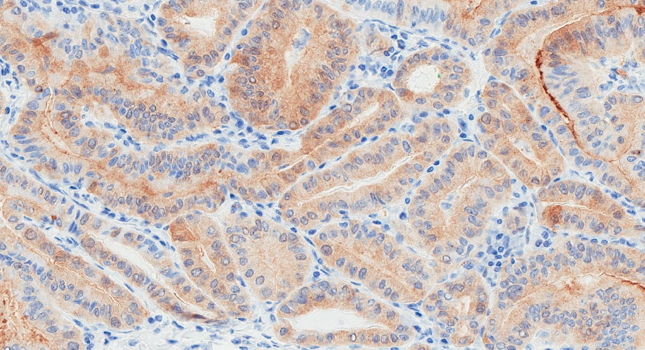 Pathology Outlines - Tall cell