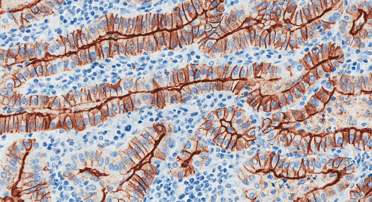 Pathology Outlines - Tall cell