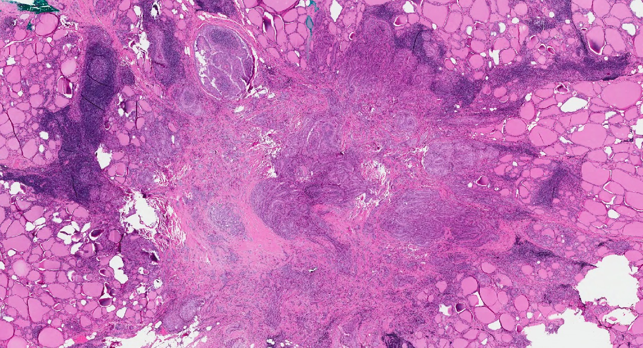 Pathology Outlines - Tall cell