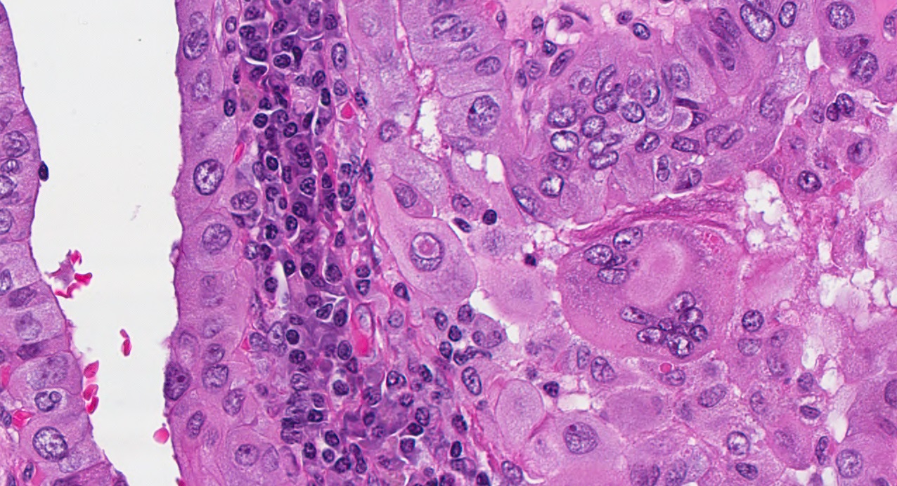 Pathology Outlines - Tall cell