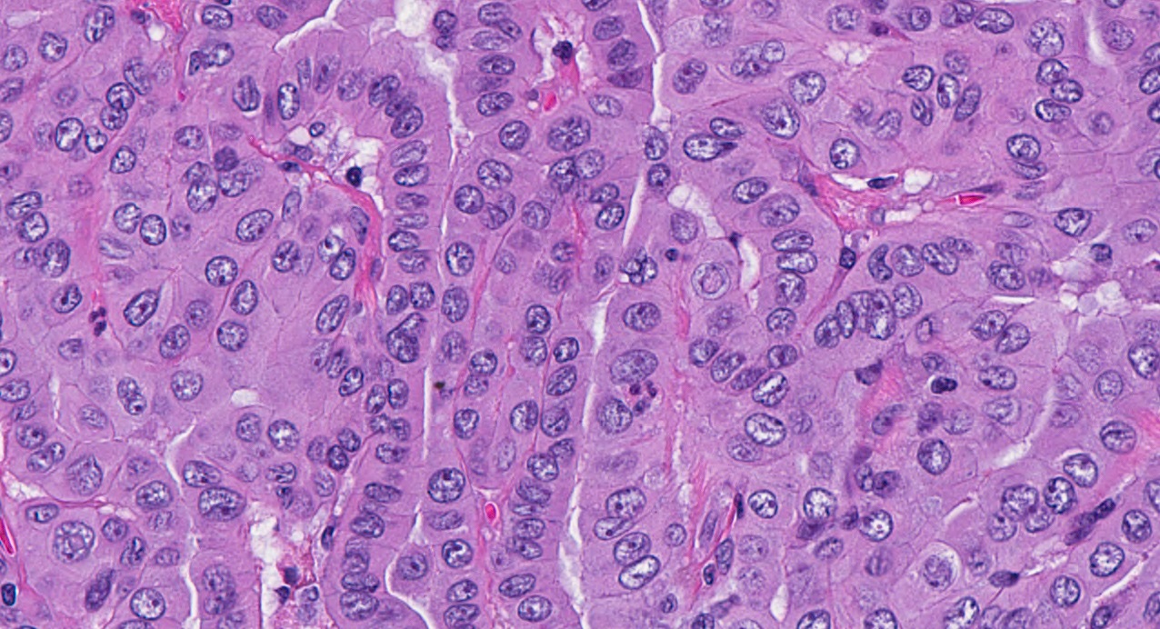 Pathology Outlines - Tall cell