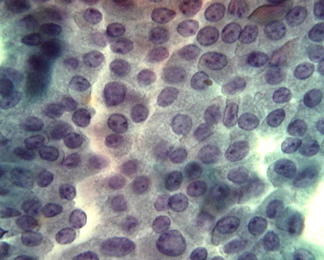 Pathology Outlines - Tall cell