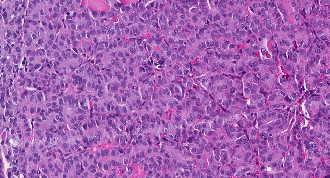 Pathology Outlines - Tall cell