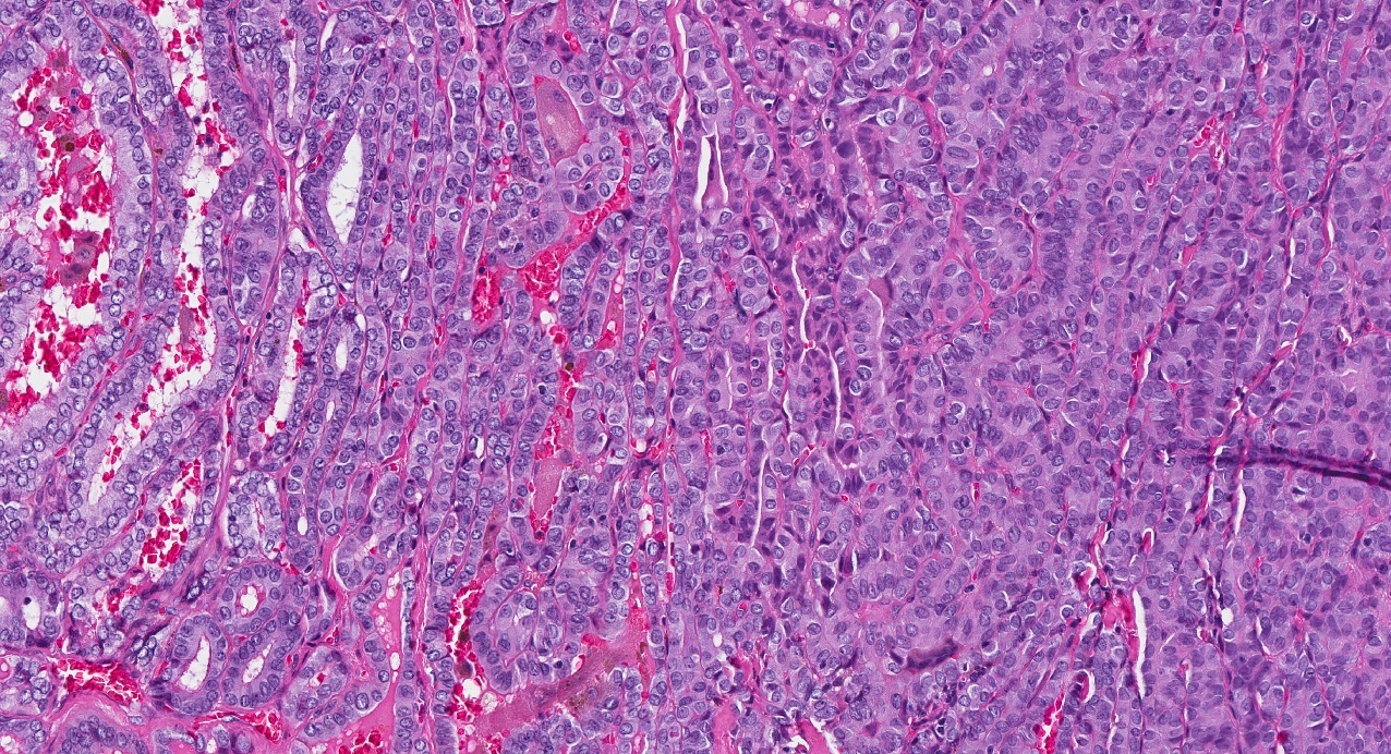 Pathology Outlines - Tall cell