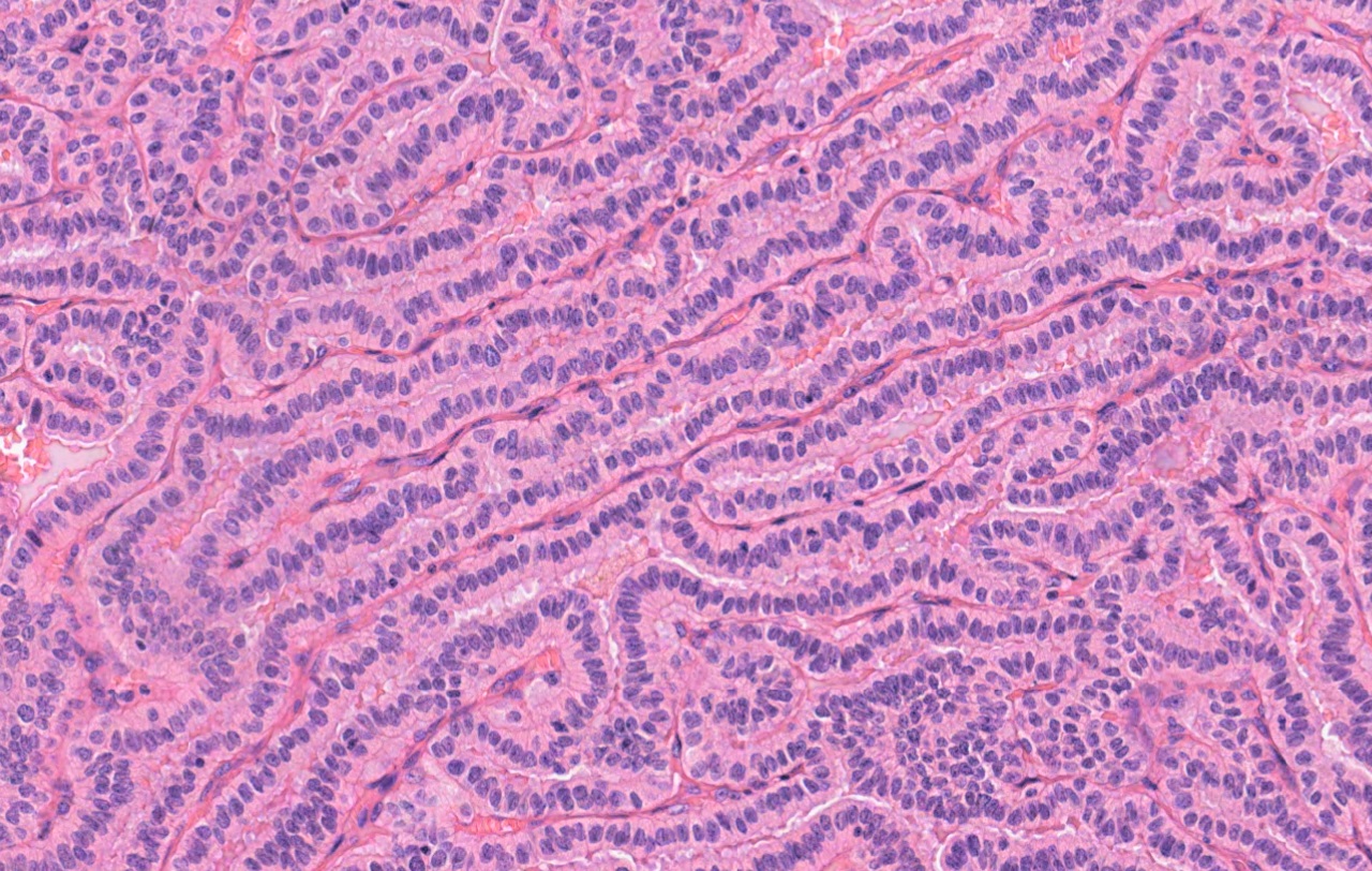 Pathology Outlines - Tall cell