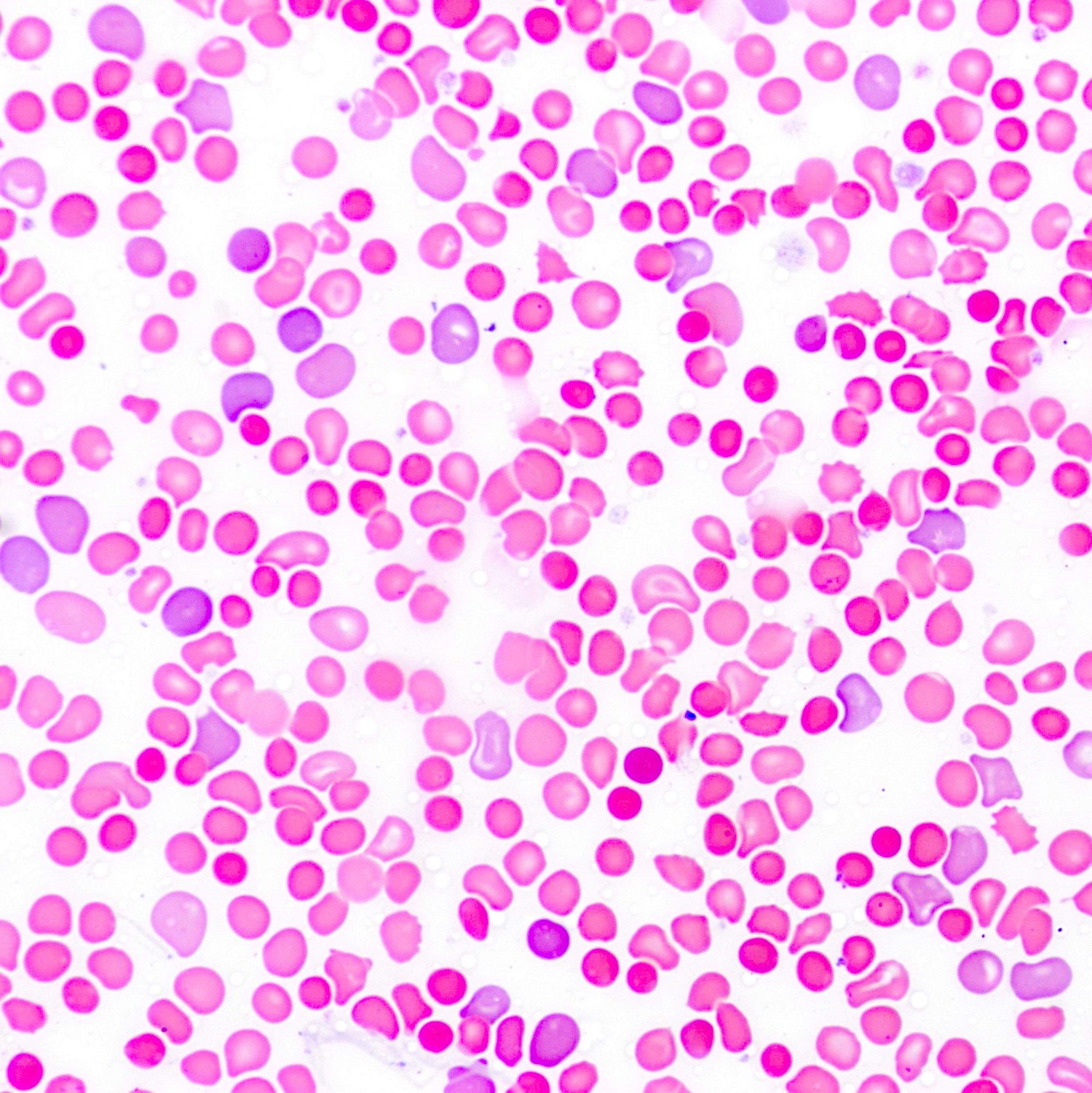 Pathology Outlines - DAT negative autoimmune hemolytic anemia