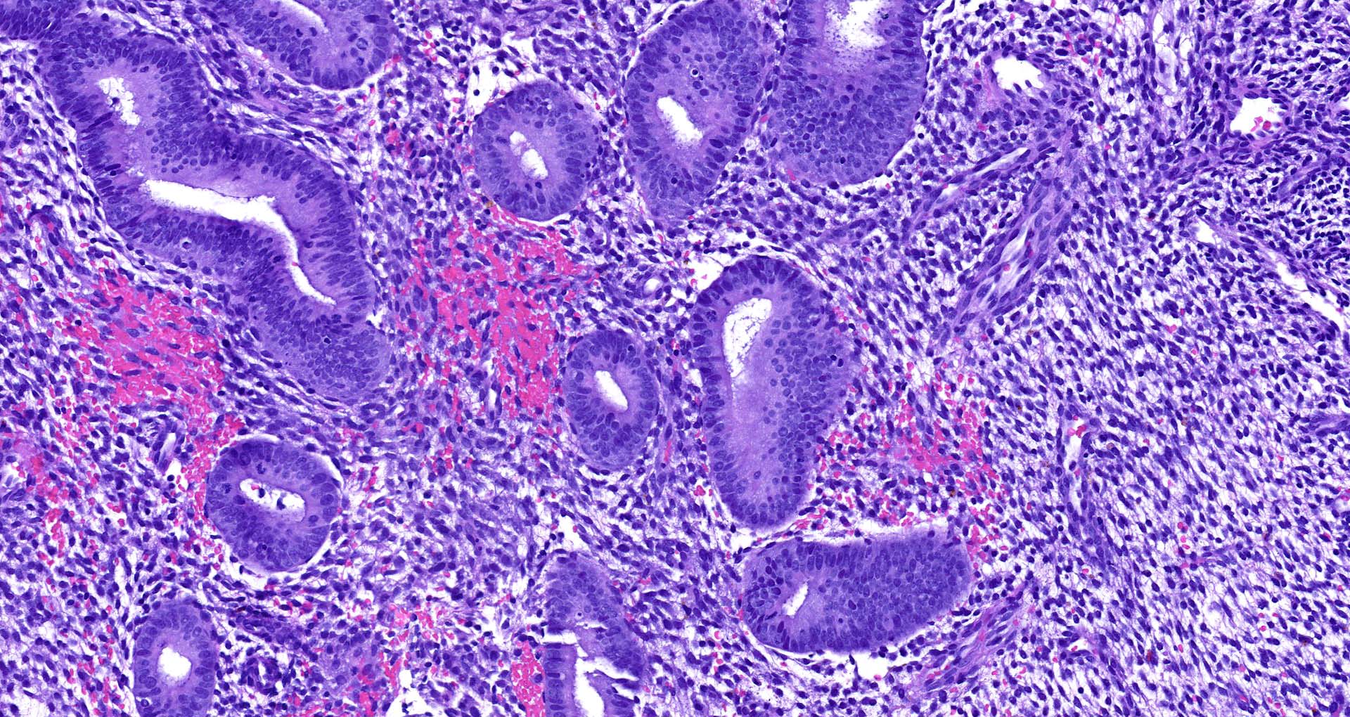 Pathology Outlines - Endometrial biopsy reporting benign / metaplasia