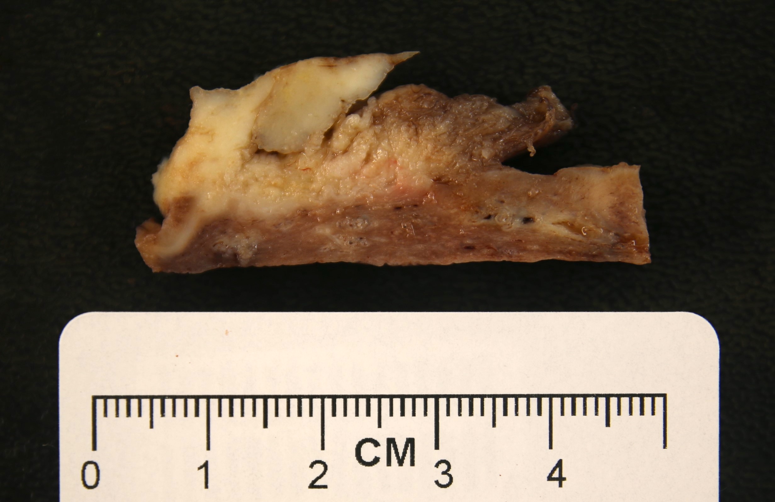 Pathology Outlines - Endometrioid carcinoma