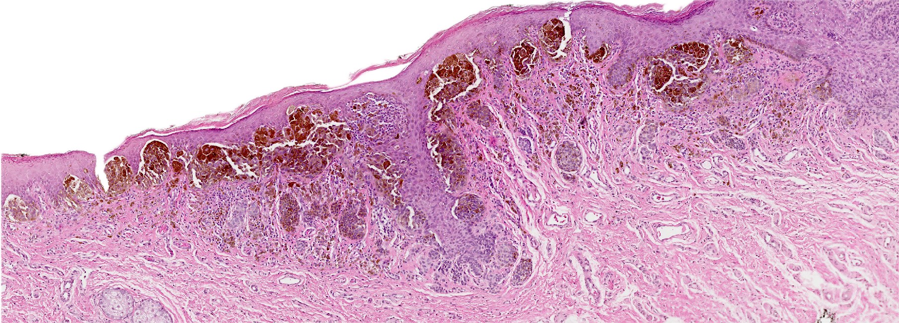 Pathology Outlines - Atypical melanocytic nevi of the genital type-vulva