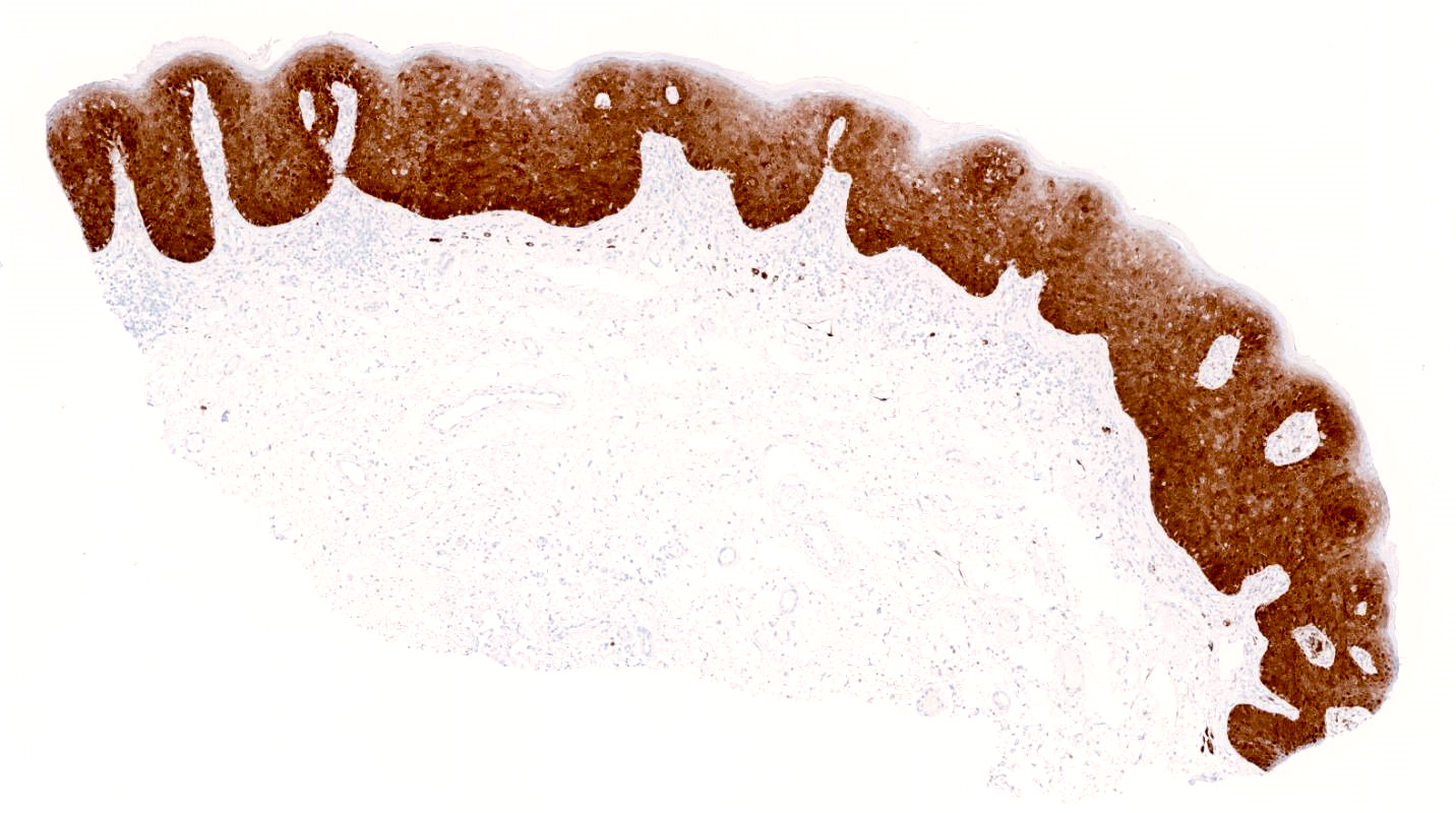 Pathology Outlines - HPV associated SIL