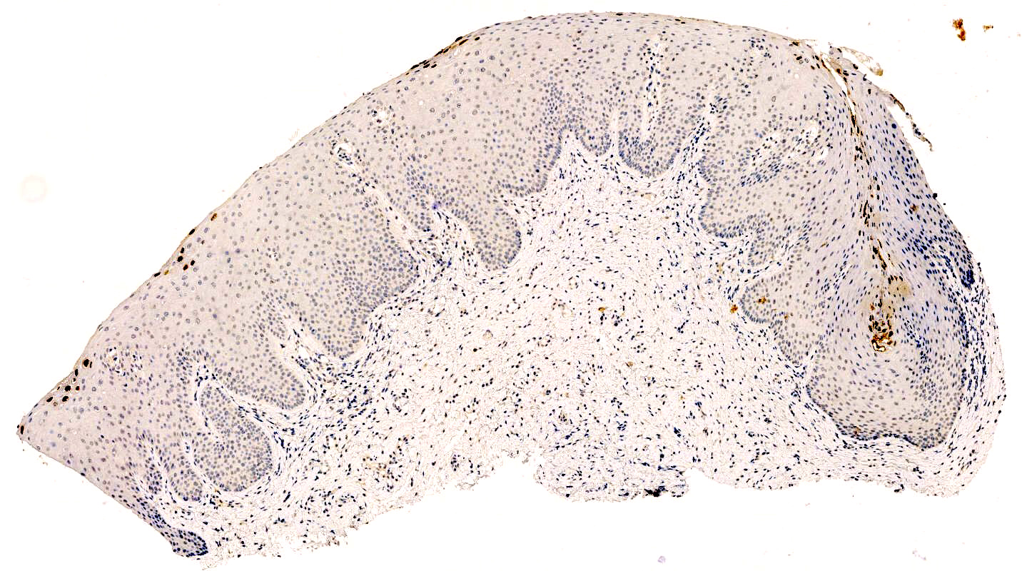 Pathology Outlines - HPV associated SIL