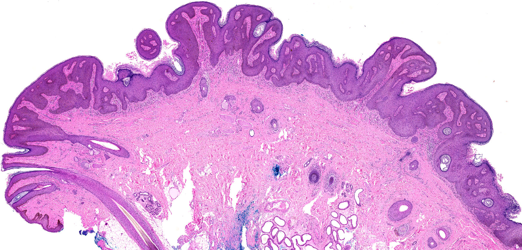 Pathology Outlines - HPV associated SIL