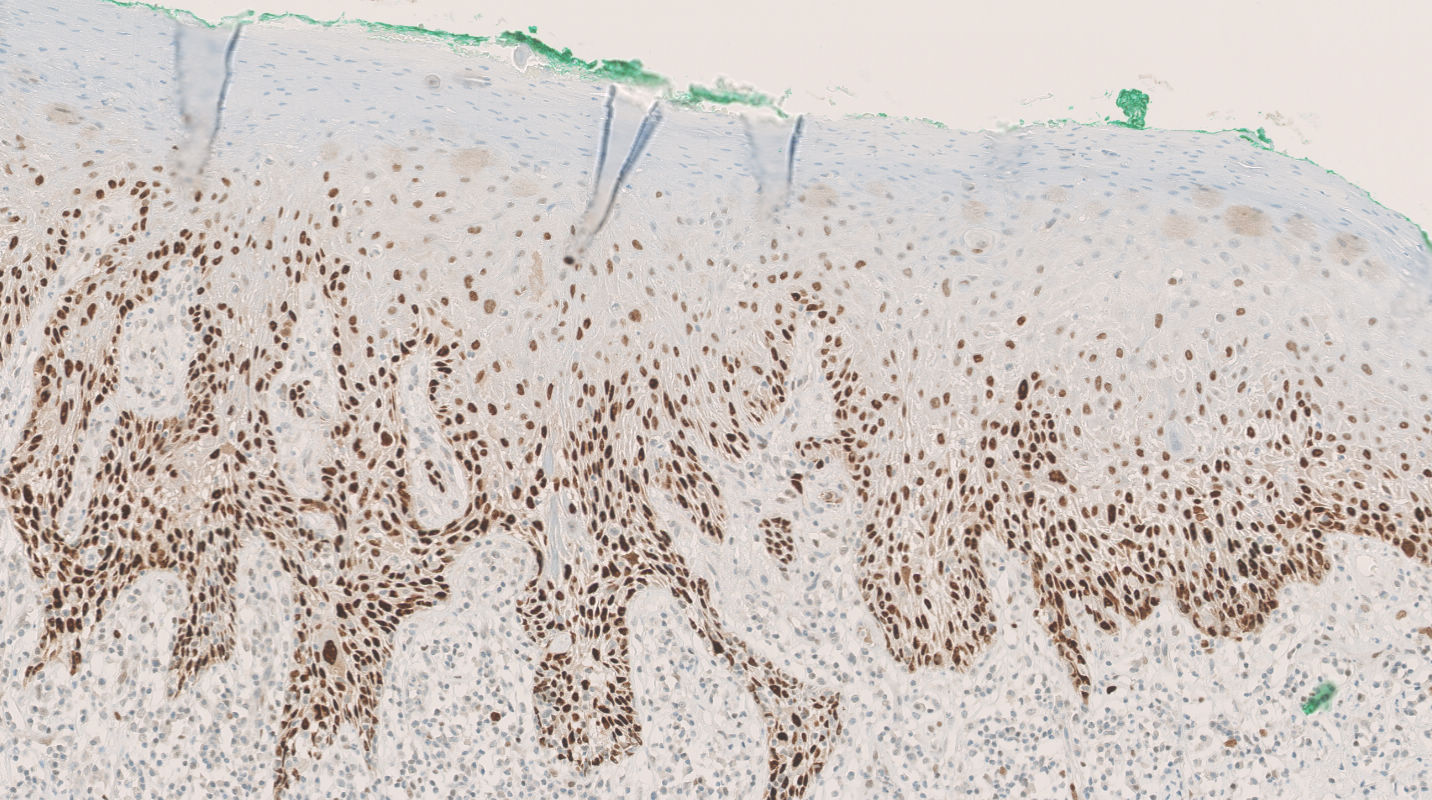Pathology Outlines - HPV independent VIN-vulva