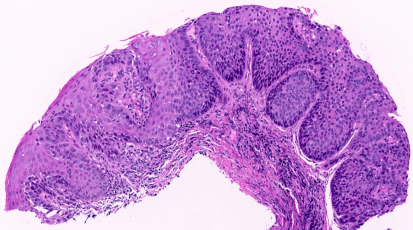 Pathology Outlines - HPV independent VIN-vulva