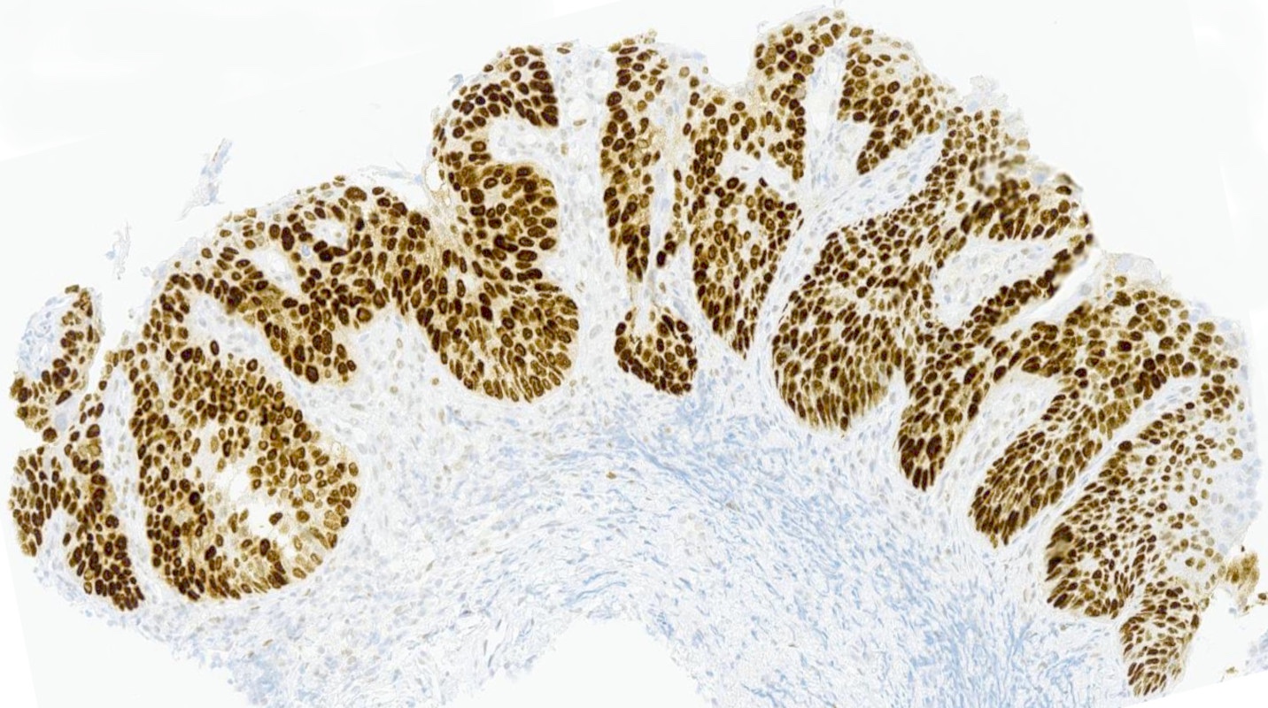 Pathology Outlines - HPV independent VIN-vulva