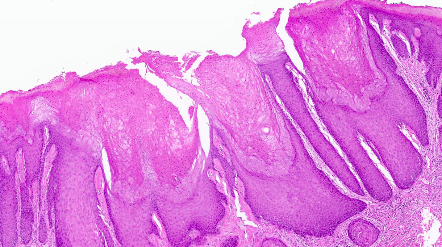 Pathology Outlines - HPV independent VIN-vulva