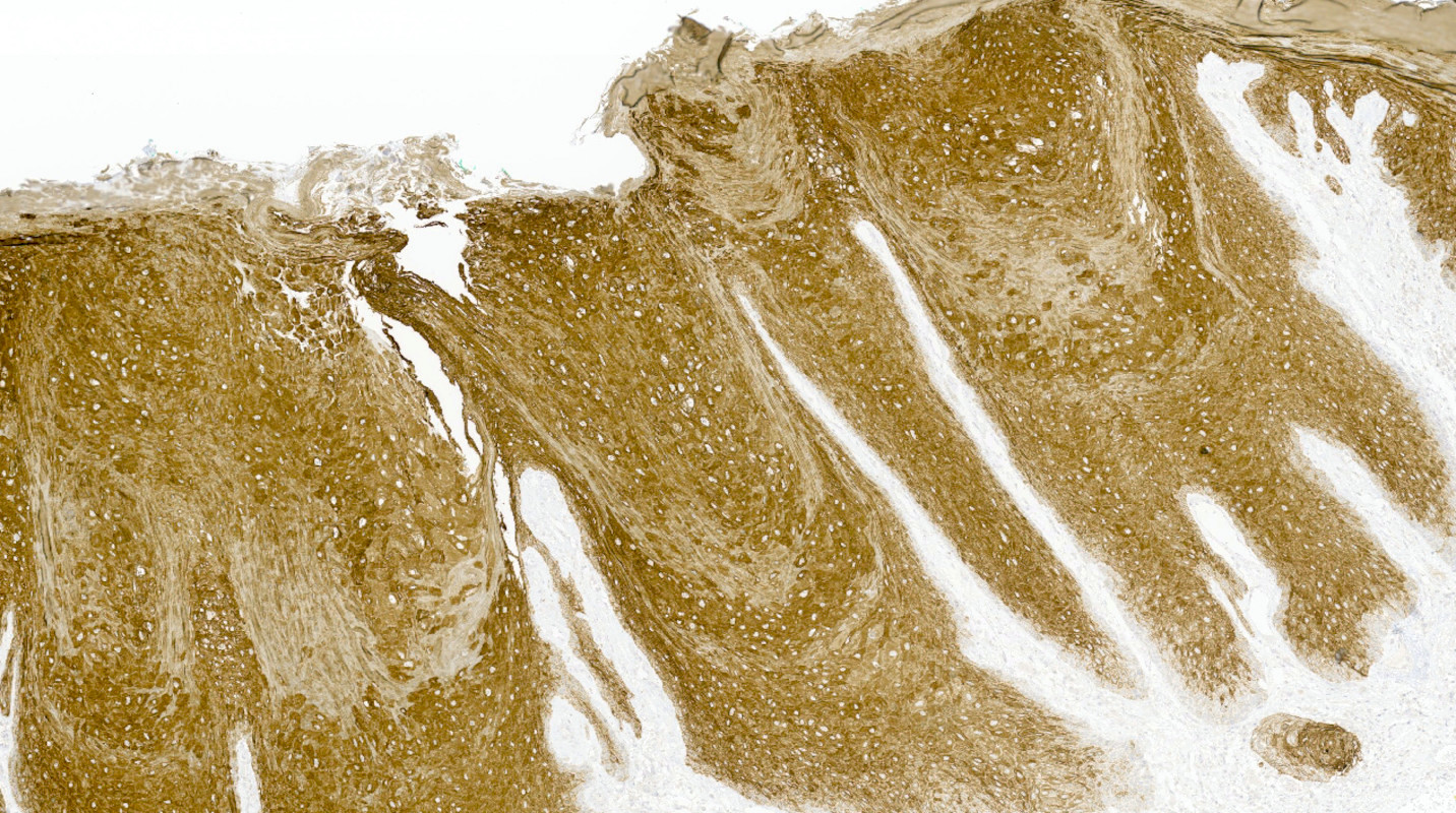 Pathology Outlines - HPV independent VIN-vulva