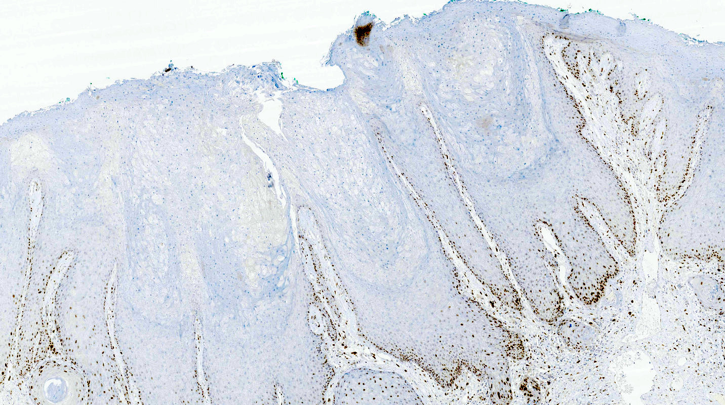 Pathology Outlines - HPV independent VIN-vulva