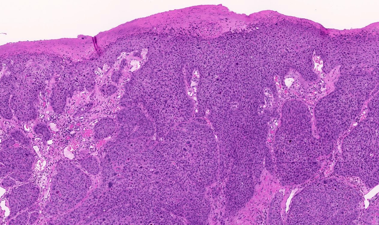 Pathology Outlines - HPV associated squamous cell carcinoma-vulva