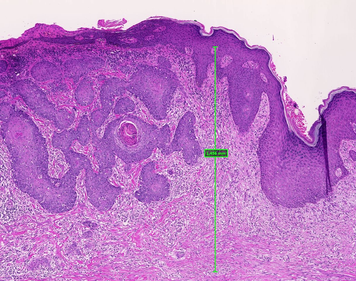 Pathology Outlines - HPV associated squamous cell carcinoma-vulva