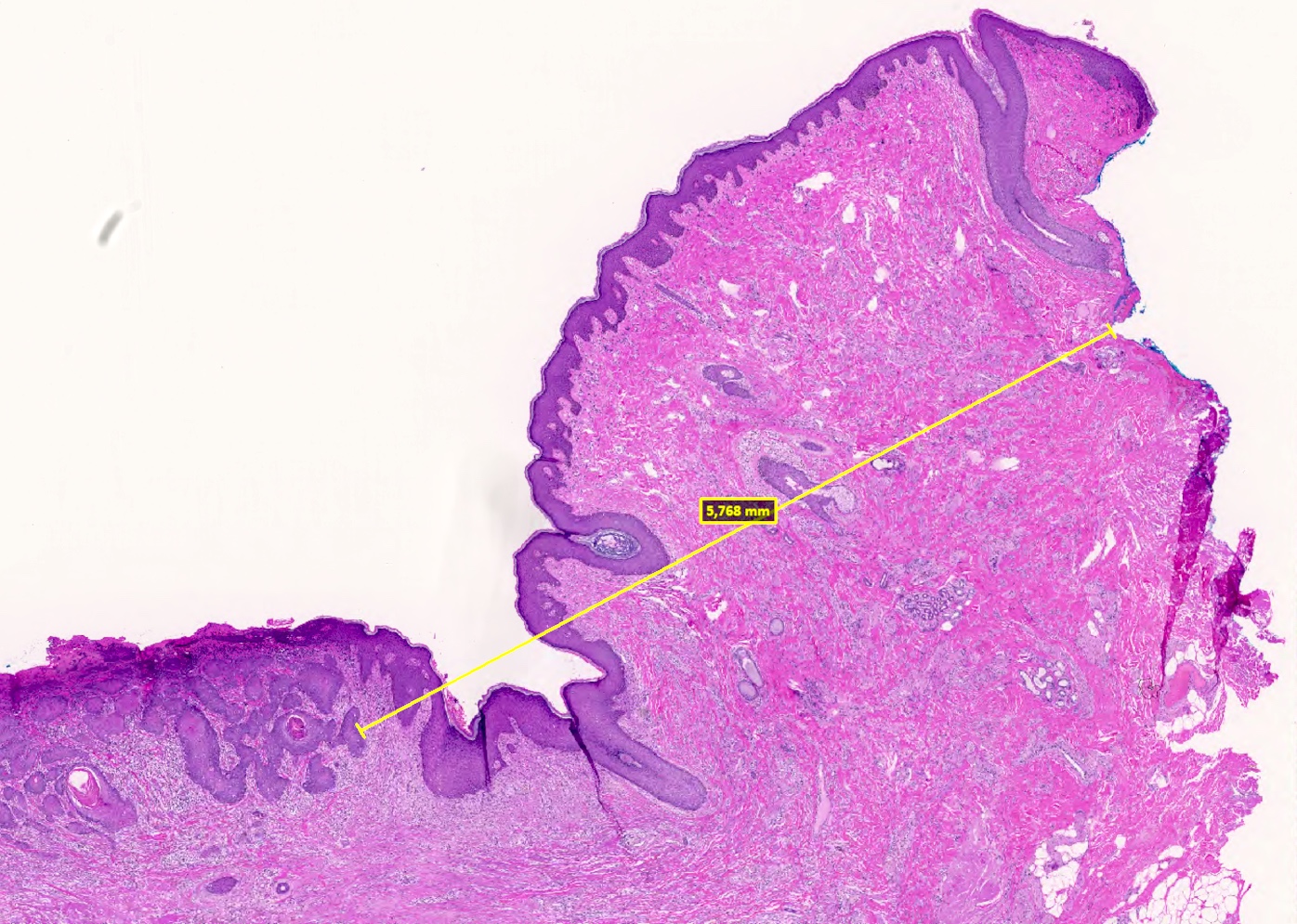 Pathology Outlines - HPV associated squamous cell carcinoma-vulva