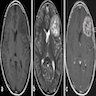 Pathology Outlines - Subependymoma