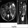Pathology Outlines - Basidiobolomycosis