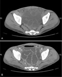 Pathology Outlines - Basidiobolomycosis