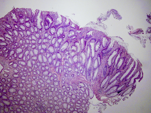 Pathology Outlines - Inflammatory cap polyp