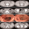Pathology Outlines - Autoimmune pancreatitis type 2