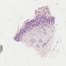 Pathology Outlines - Porokeratosis
