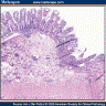 Pathology Outlines - Ulcerative colitis