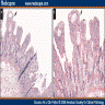 Pathology Outlines - Ulcerative colitis